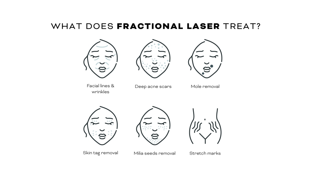 Fractional Laser - Astique Clinic